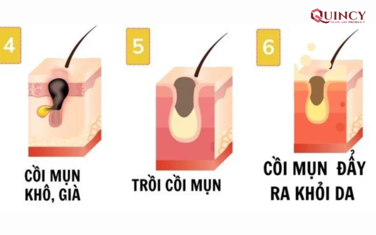 Serum trị mụn se khít lỗ chân lông " hiệu quả tốt nhất " - Quincy ...